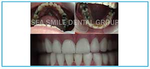 Seasmile Cerec3d Case At Sea Smile Dental Clinic, We provide the wide range of dental treatments ...